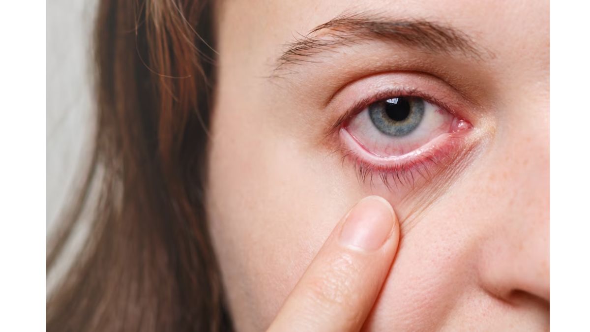 Eye Flu Cases Rise Amid Floods In India; Know Causes, Symptoms And ...
