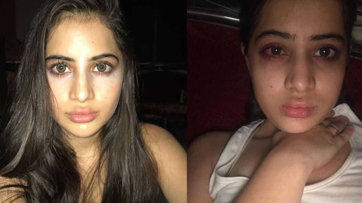 Urfi Javed Shares Her Experience With Lip Fillers; All You Need To Know ...