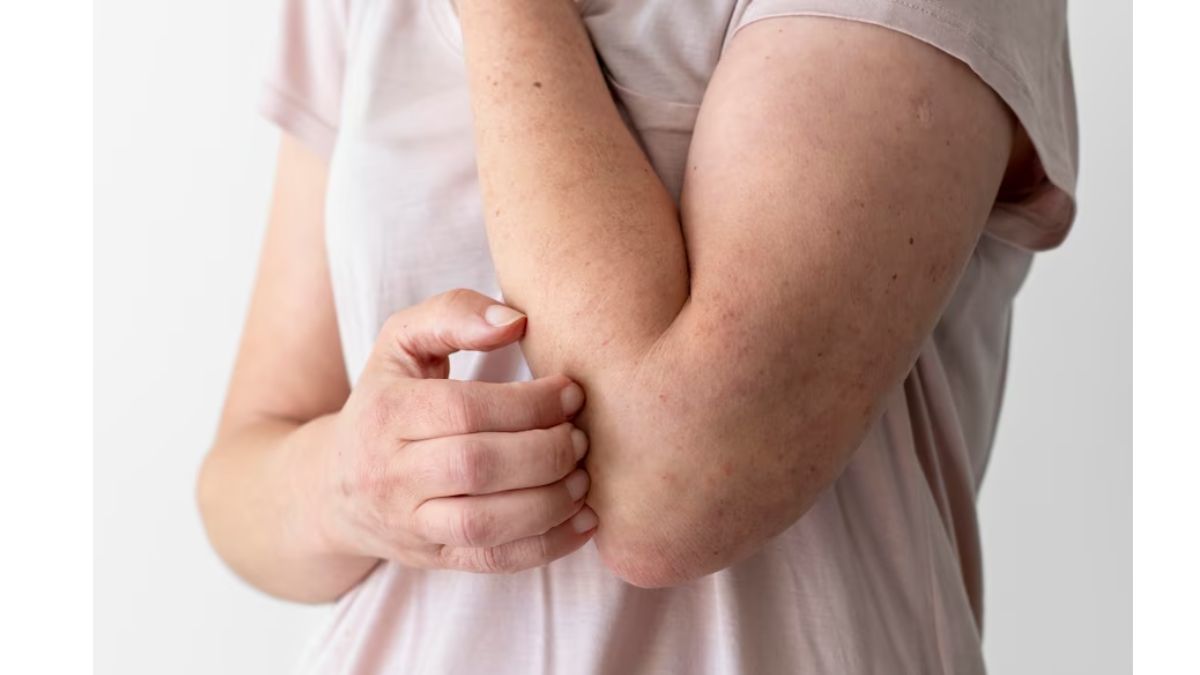 New Chicken Pox Causing Virus Variant ‘Clade 9’ In India: Know Symptoms ...