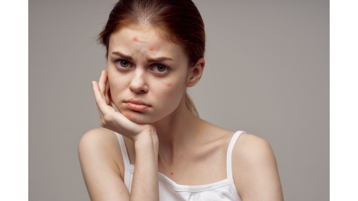 5 Ways Prolonged Stress May Be Affecting Your Skin | Persistent Acne To ...