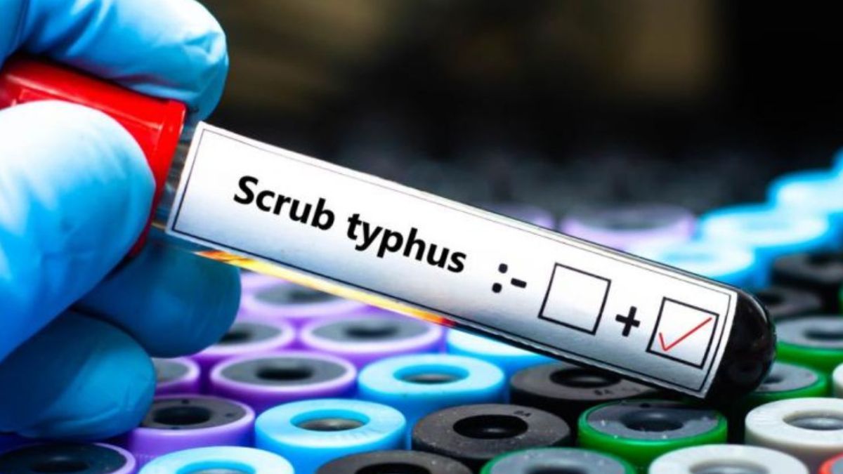 Scrub Typhus Cases Rise In Odisha: 5 Ways To Prevent This Mite-Borne ...