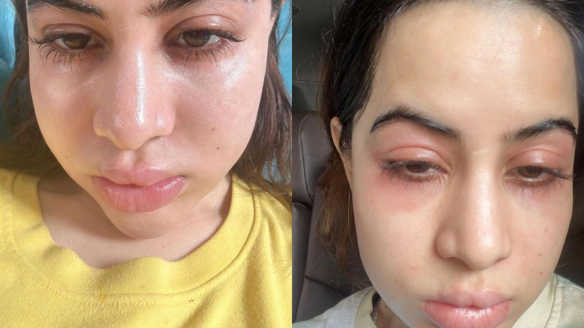 Urfi Javed Shares Pictures Of Her Swollen Face; Says ‘I Have Major Allergies’ | Know Foods That ...
