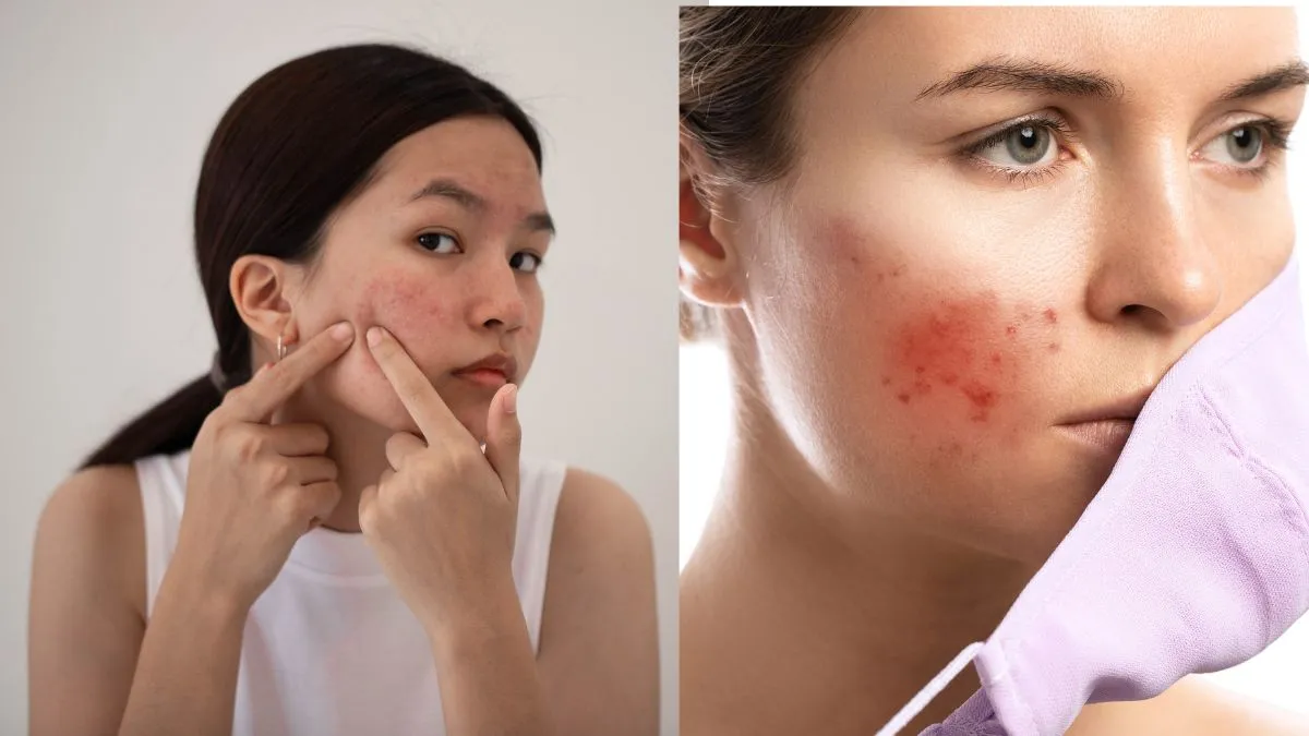 4 Ways In Which Poor Sleep Can Hamper Your Skin Health | Acne To Breakouts