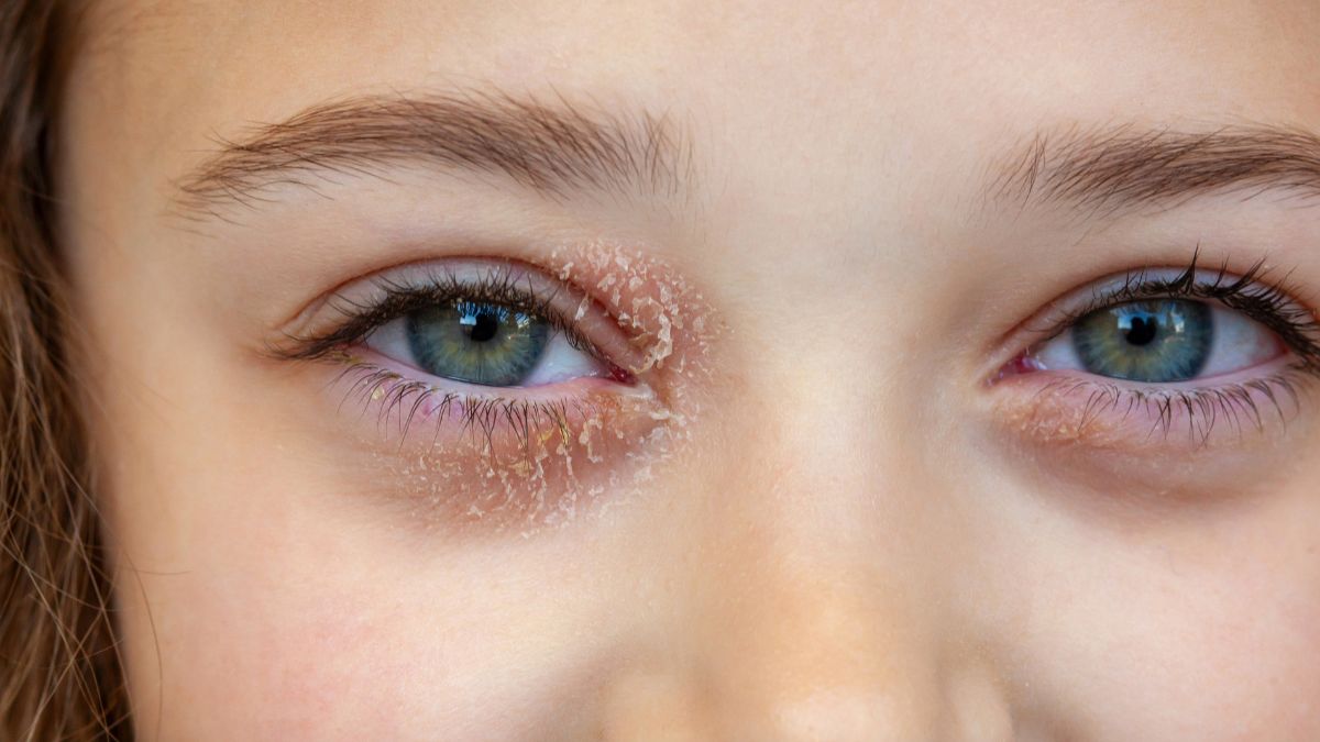 What Is Eyelid Dermatitis And How It Aggravates In Monsoon? Know Ways ...