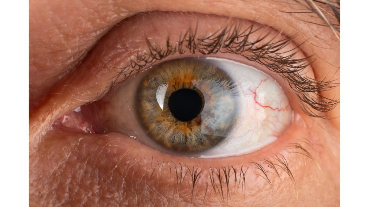 Jasmin Bhasin Suffers From Corneal Damage: Know Causes, Symptoms ...