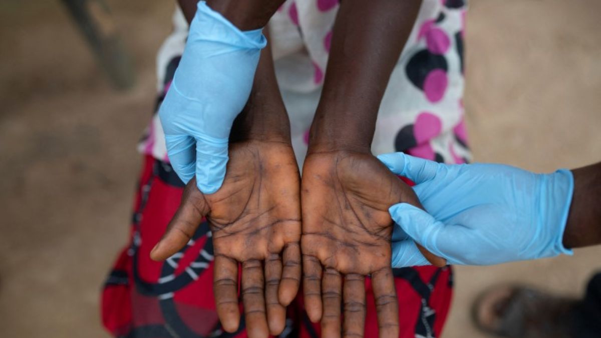 Mpox Scare: Delhi Govt Orders Three Hospitals To Prepare Isolation ...