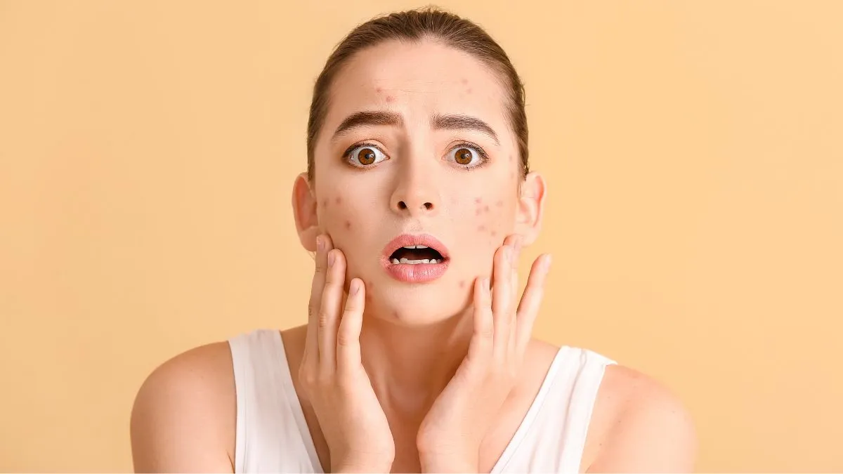 Top 10 Effective Tips To Achieve Acne-Free Skin Naturally At Home ...