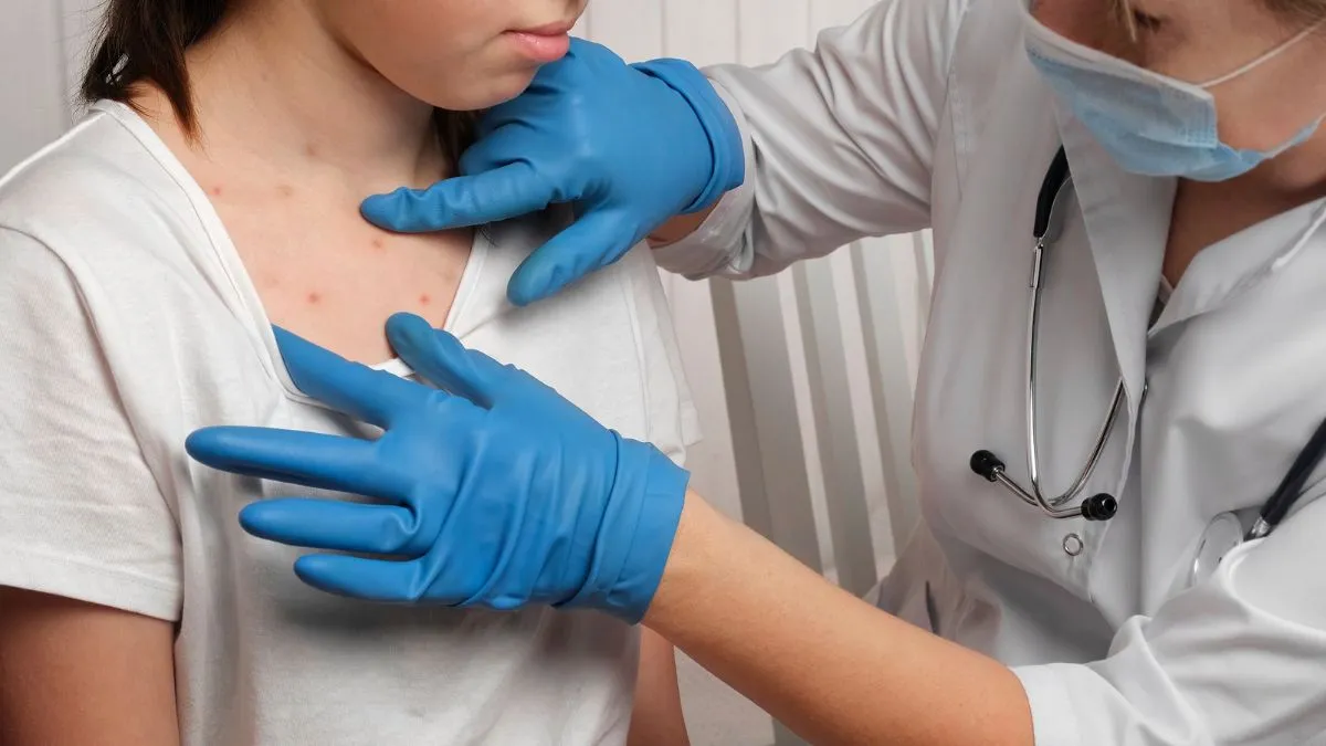 Mpox In India: 5 Essential Precautions To Minimise Your Infection Risk