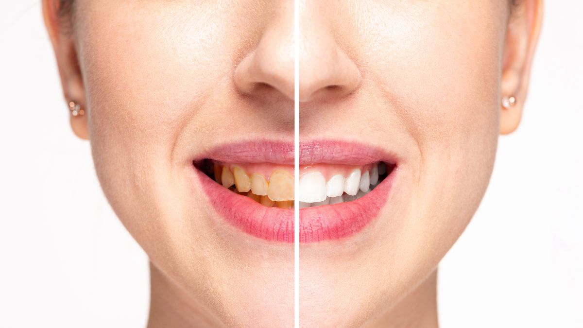 Check These 5 Simple Home Remedies To Easily Get Rid Of Yellow Teeth ...