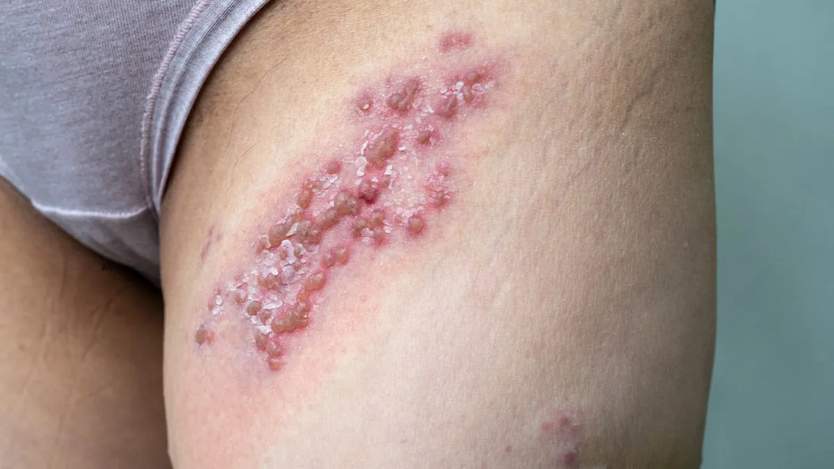 Signs Of Genital Herpes Expert Lists Warning Signs To Never Ignore