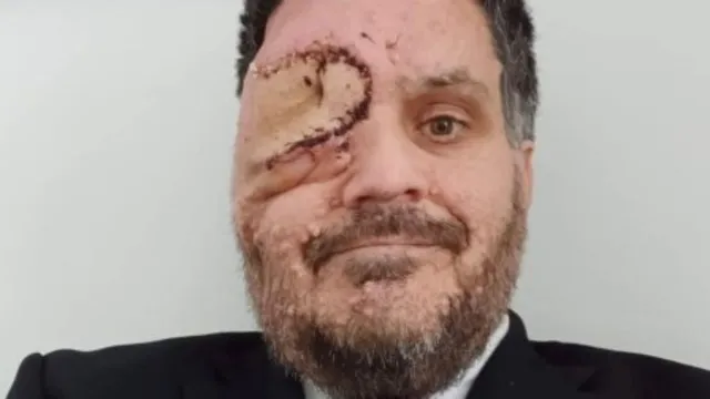 London Man With Facial Disfigurement Asked To Leave Restaurant After ...