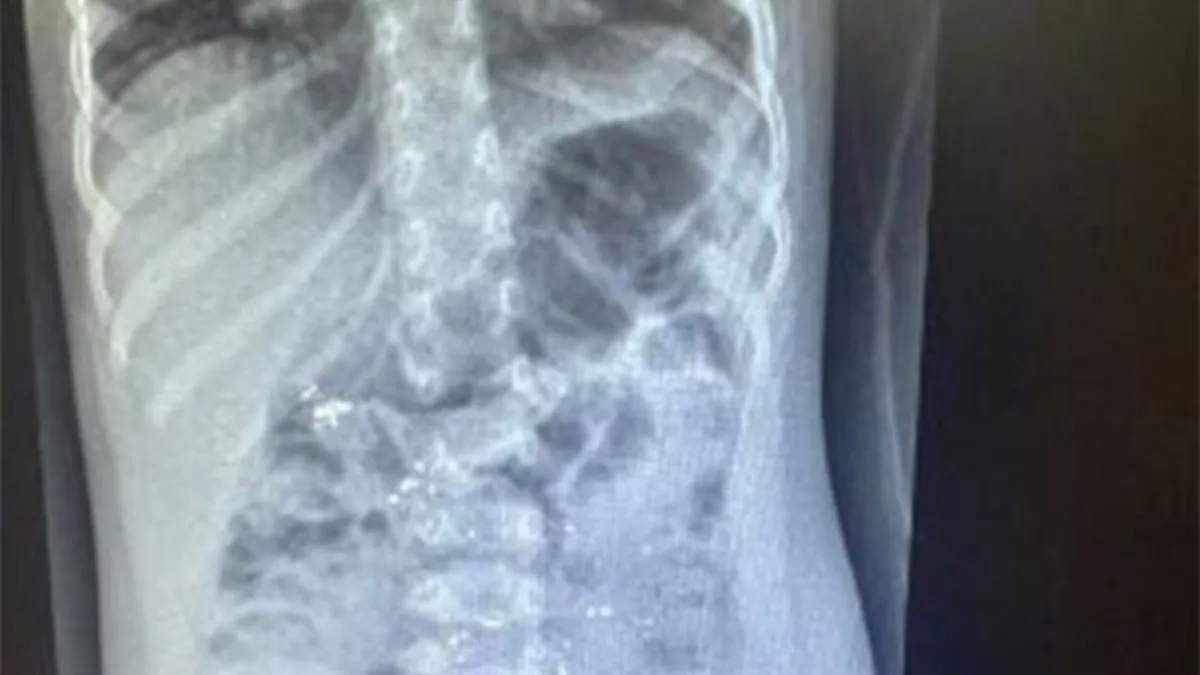 Delhi: Two-Year-Old Child Swallows Mercury After Thermometer Breaks In ...