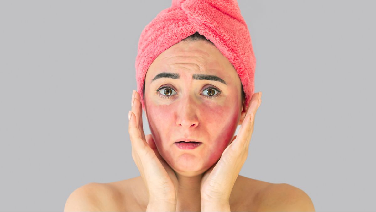 5 Easy Ways To Get Rid Of Winter Rashes From Your Face