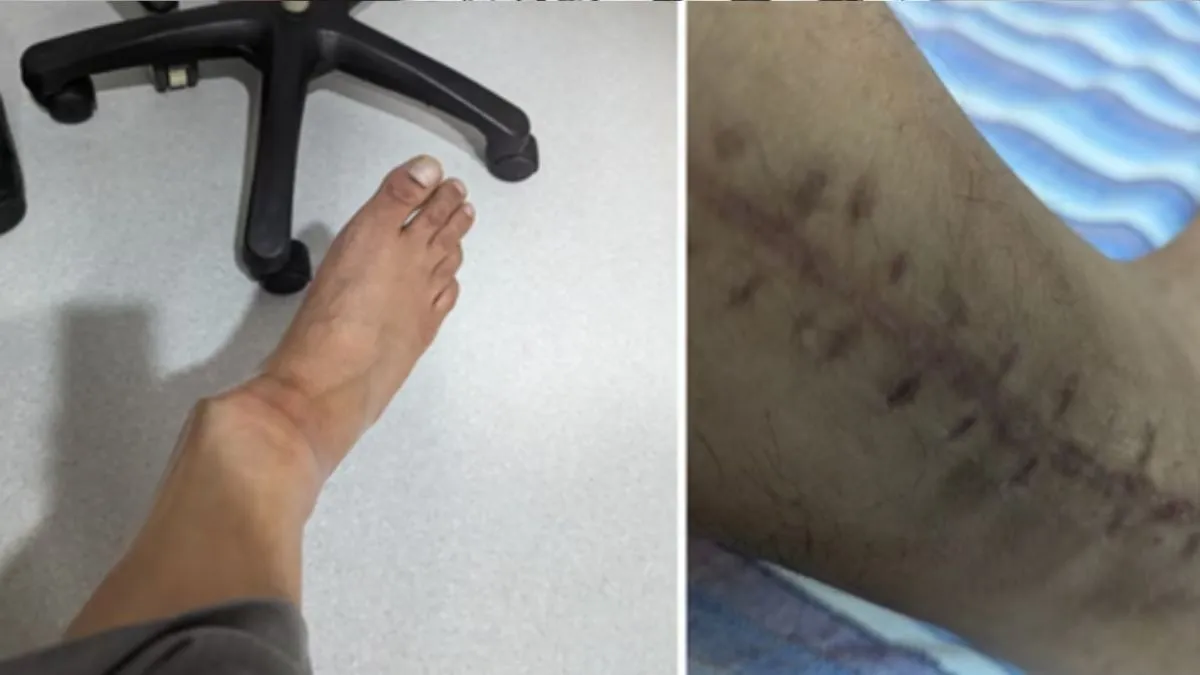 Gurugram: IndiGo Passenger Undergoes Ankle Surgery After Slipping On ...