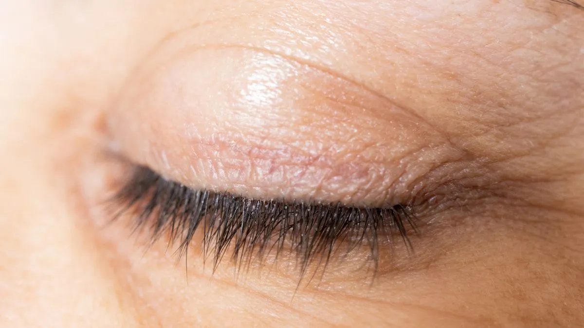 Eyelash Dandruff Doctor Explains Symptoms Risk Factors And Treatment