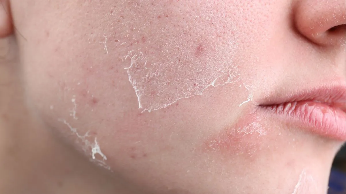 Dry patches on face store