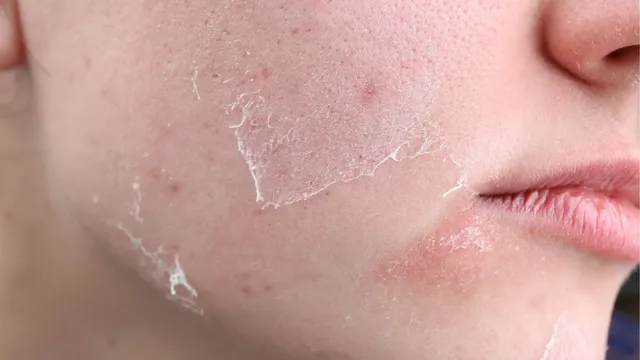 Do You Have Dry Patches On Your Face? Know 4 Major Causes