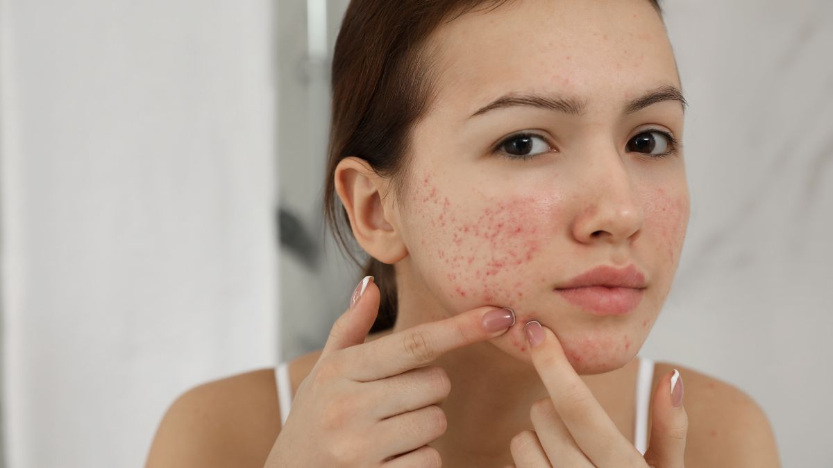 Try These 4 Natural Ways To Reduce Acne Marks From Your Face