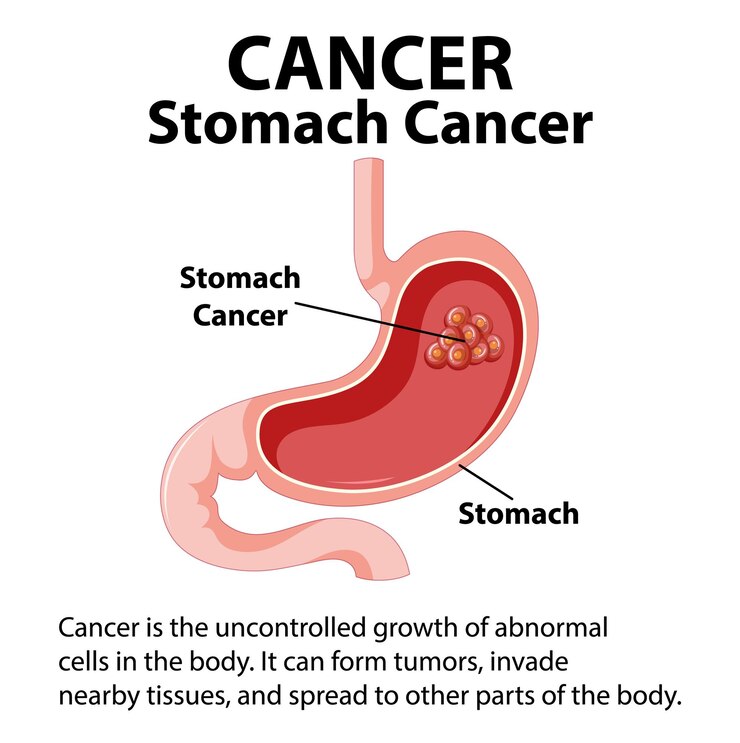 Stomach Cancer Warning Signs: Is It Hereditary? Doctor Explains The ...