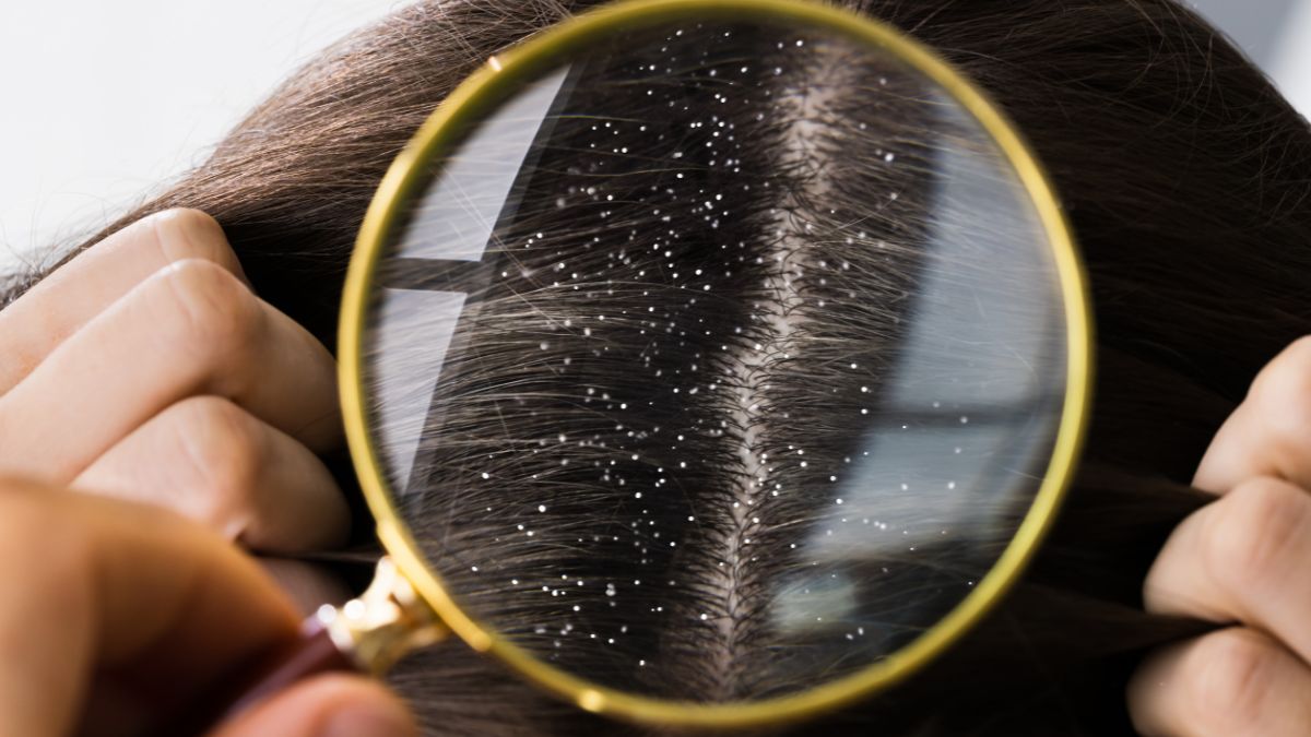 5 Effective Ways To Get Rid Of Dandruff In Winters Naturally