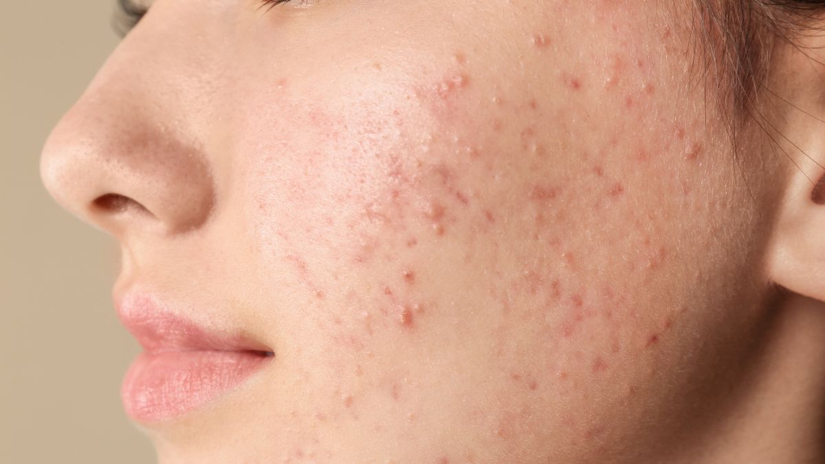5 Home Remedies To Heal Acne Naturally During Winter