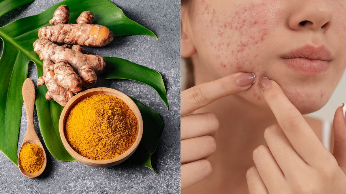 Turmeric For Acne: 5 Ways To Use This Spice To Brighten Skin And Reduce ...
