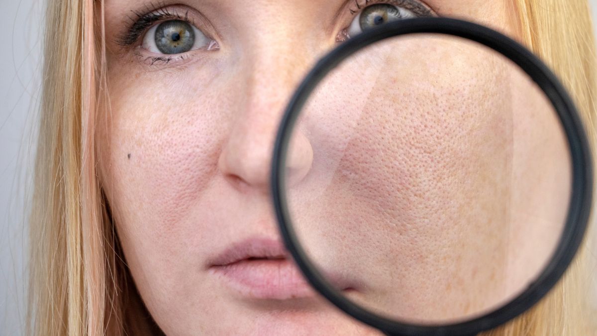 5 Home Remedies To Reduce Enlarged Pores On Your Face