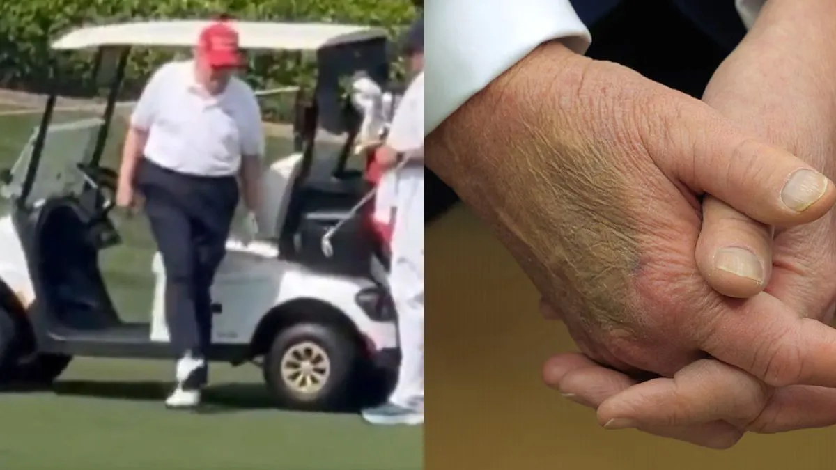 Donald Trump’s "Dragging Leg" And "Bruised Hand" Video Sparks Health ...