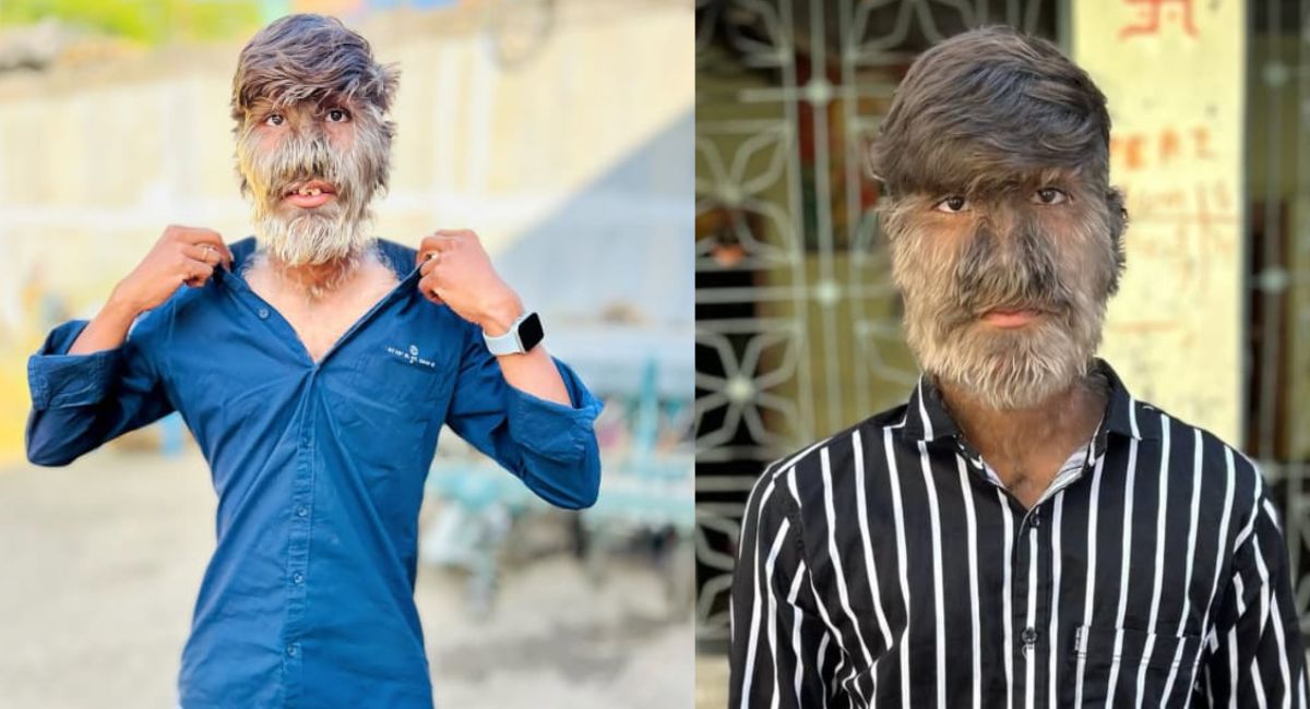‘Hairiest Face’: Indian Teen With Werewolf Syndrome Sets Guinness World ...