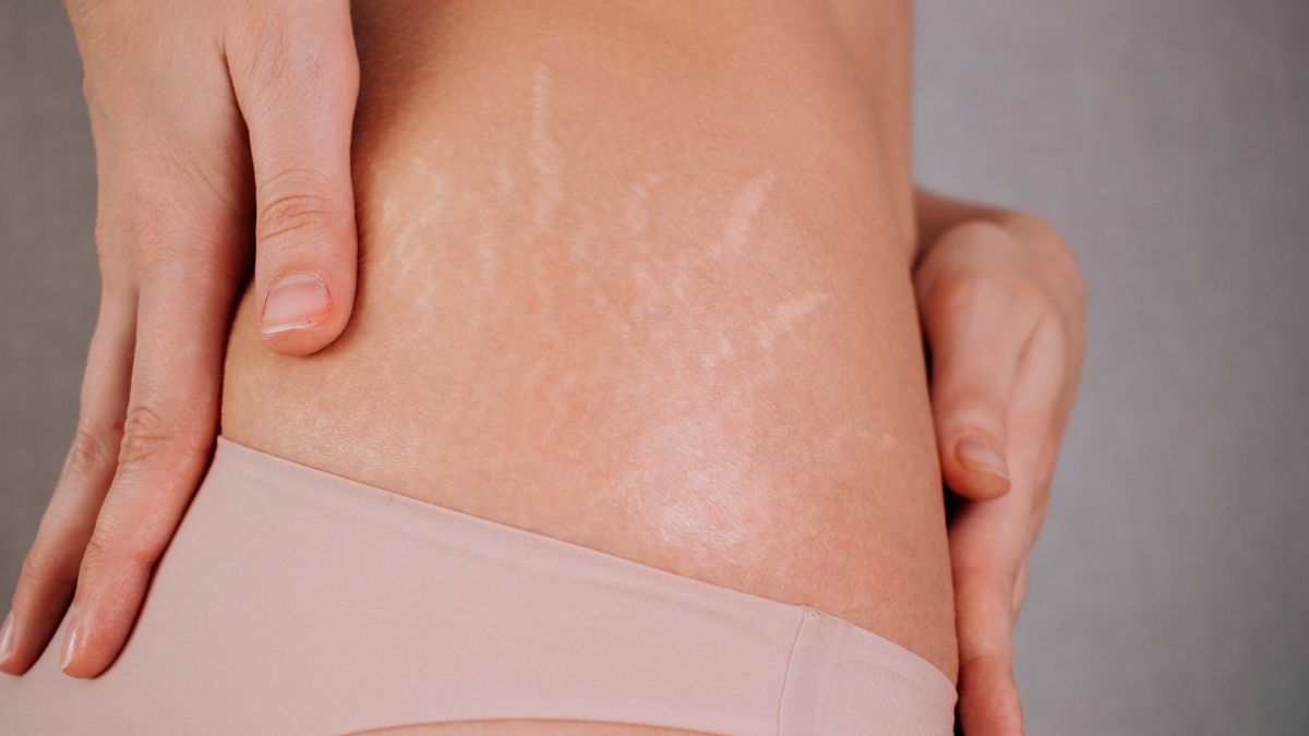 5 Home Remedies To Naturally Fade Stretch Marks Fast