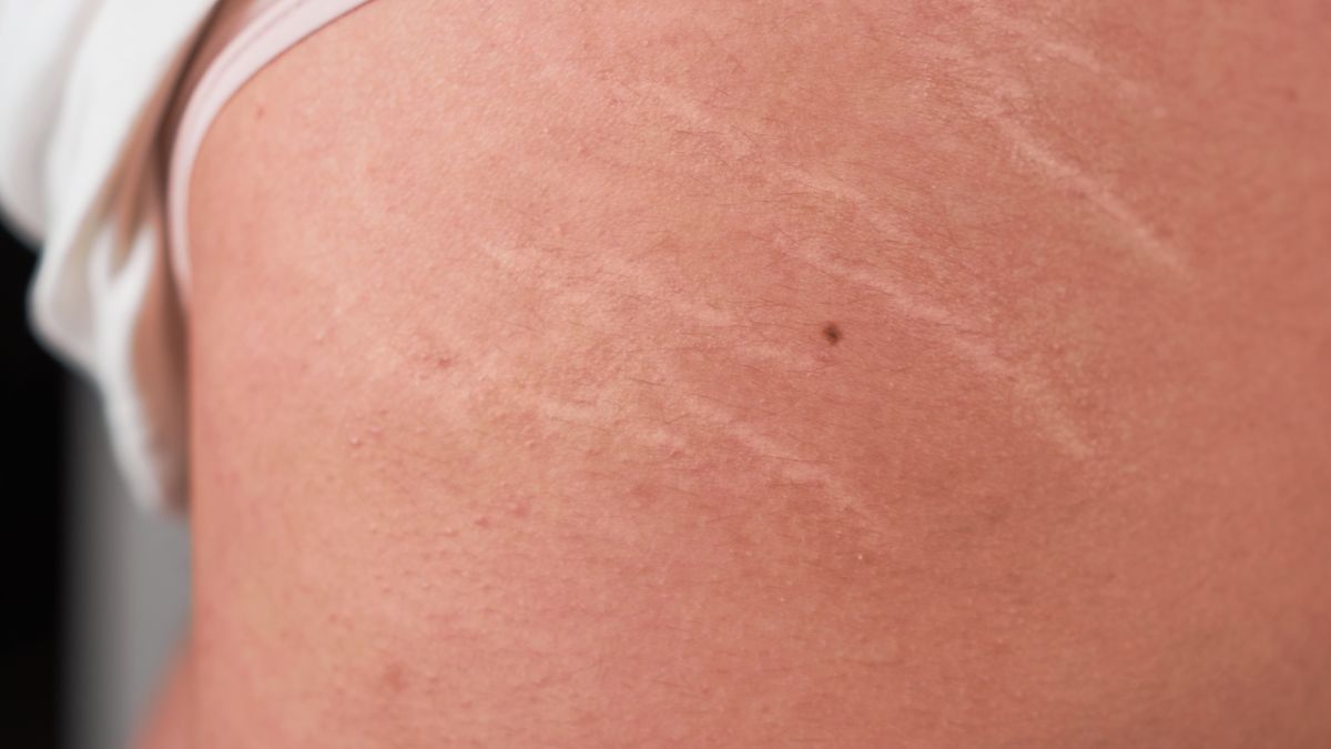 5 Home Remedies To Naturally Fade Stretch Marks Fast