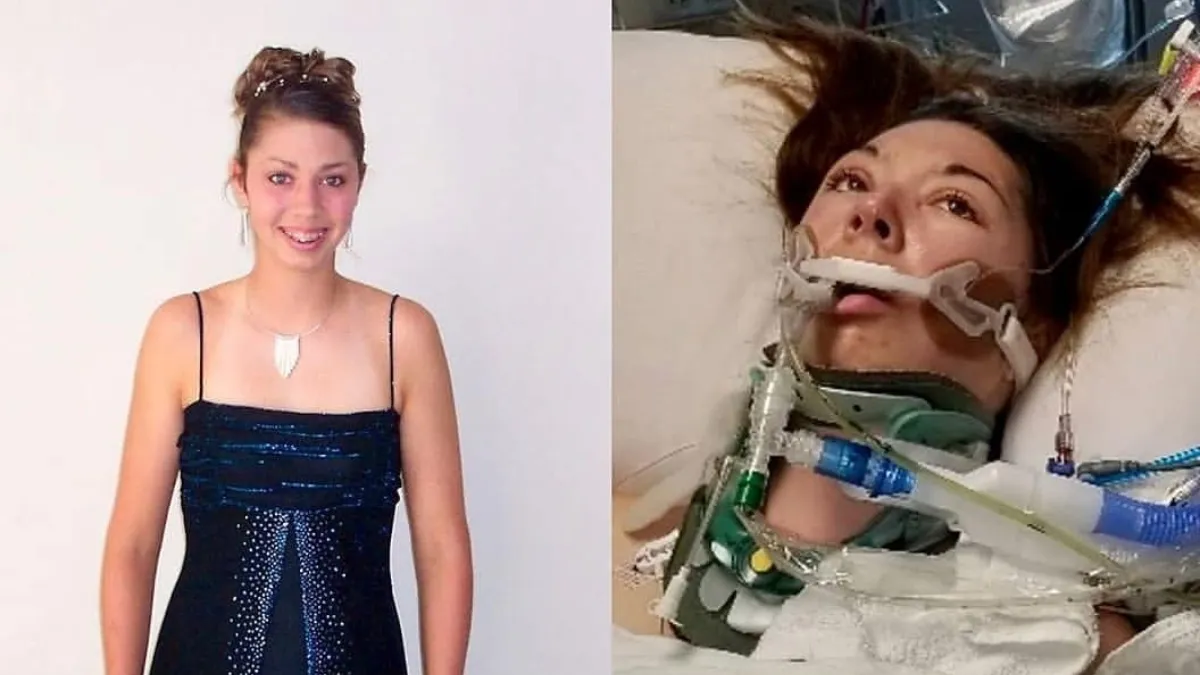 US Woman’s Spine-Shocking Survival: 37 Surgeries To Reattach Head