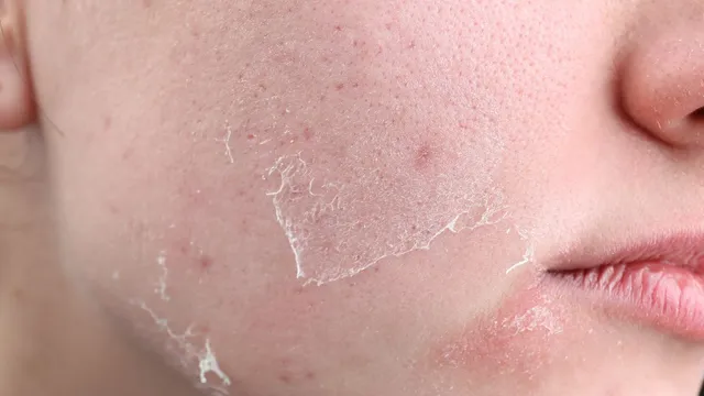 What Is Caveman Skincare? All About 'No Soap' Trend To Achieve Healthy Skin