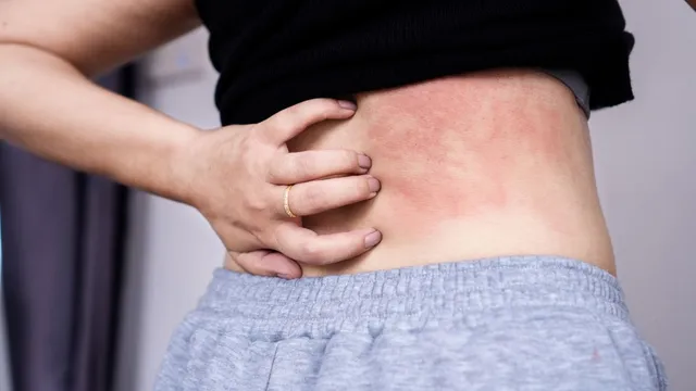 Heat Rashes In Summer: 5 Proven Tips To Treat This Skin Issue In Hotter ...