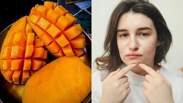 Can Eating Mangoes Really Give You Pimples? Here's What You Should Know