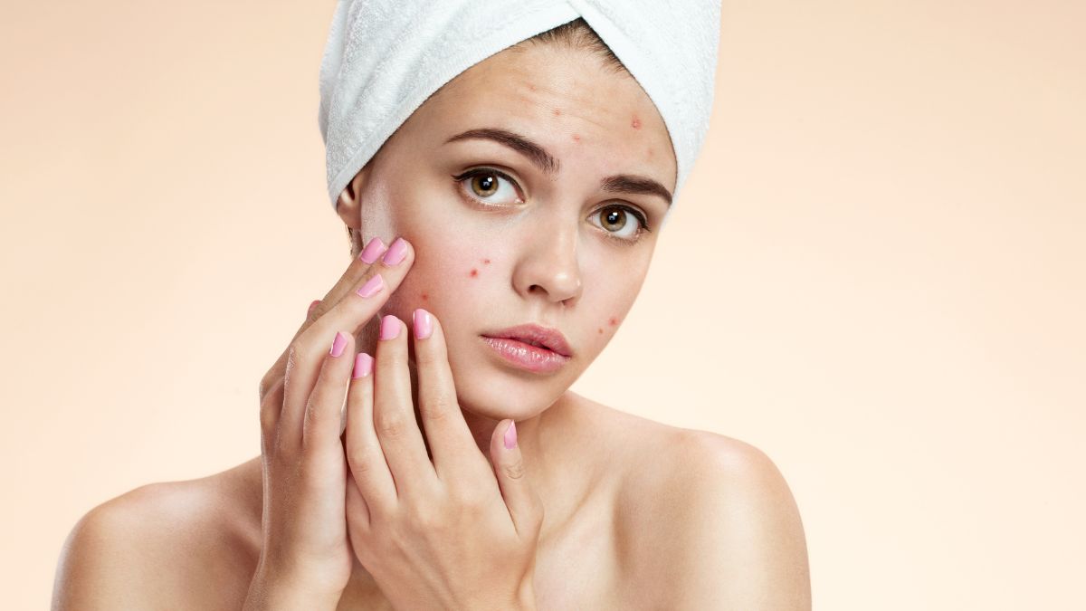 7 Painless Tips To Hide Your Pimples And Achieve Clear Skin