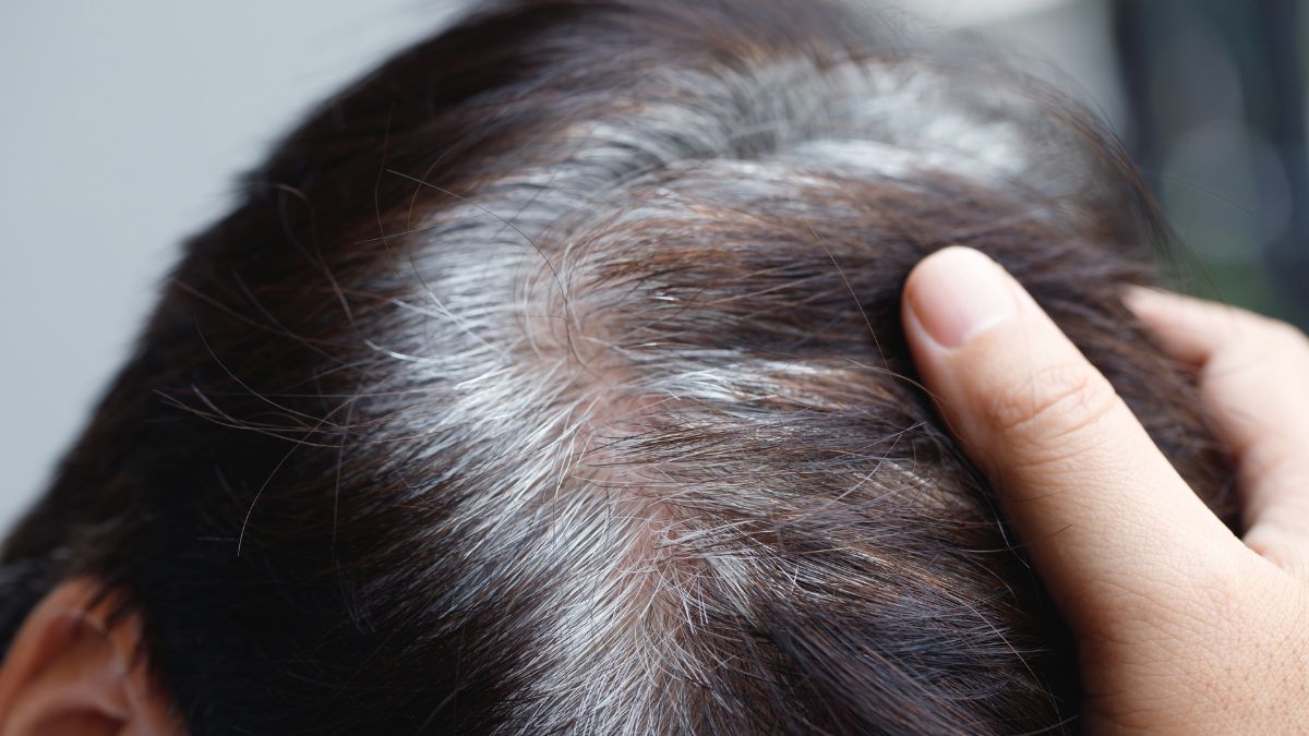 What Causes Premature Greying Of Hair In Teens? Here's How You Can ...