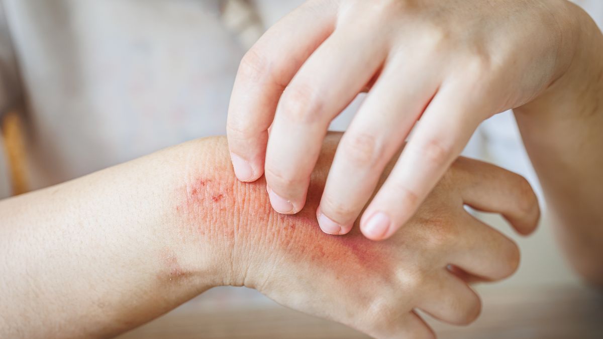 How To Prevent Fungal Infections In Summer? Doctor Shares Simple Tips ...