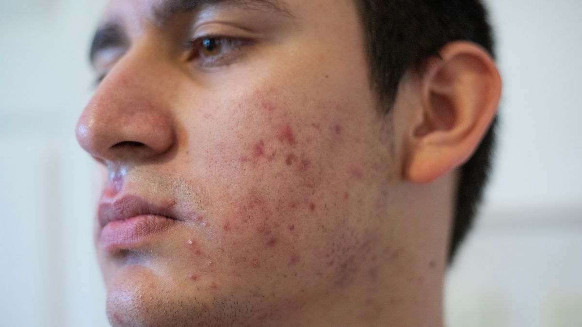 What Are The Common Skin Problems In Men And How To Manage Them? Know ...