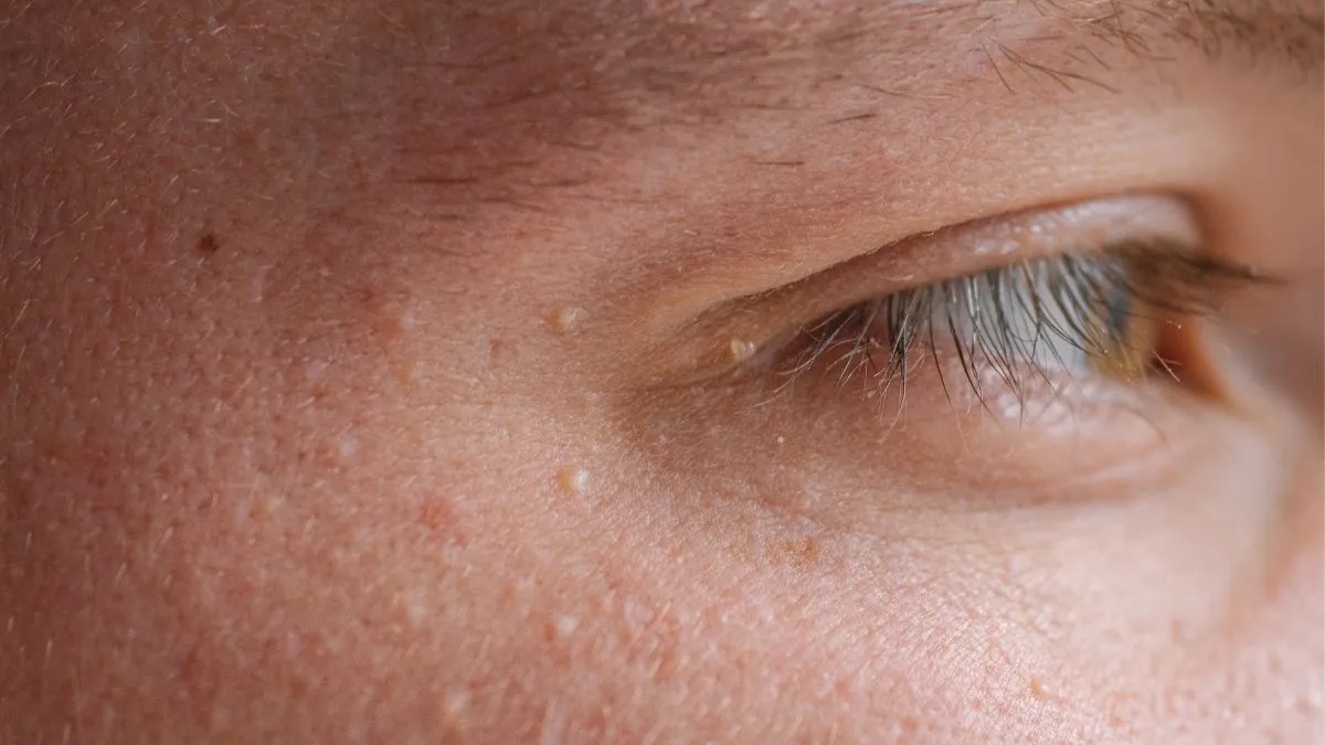 Getting White Bumps On Your Face? 7 Natural Home Remedies To Remove Milia