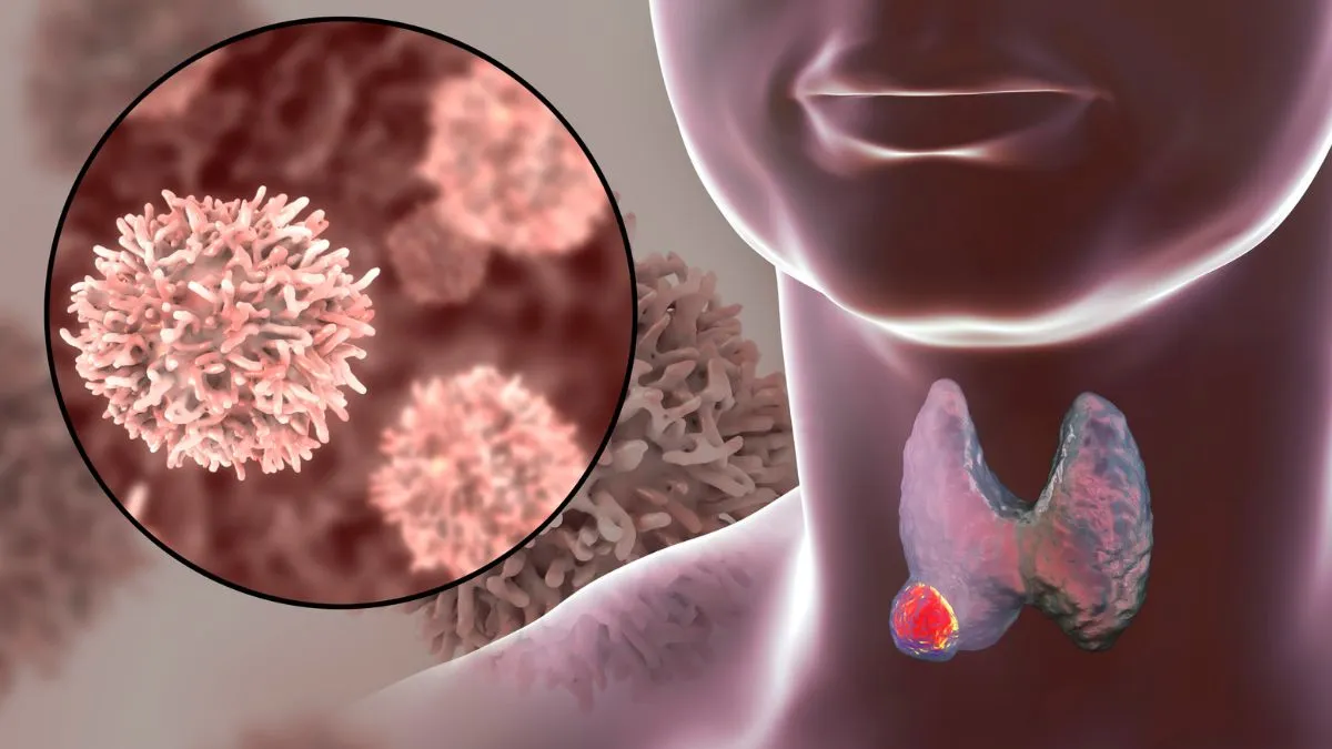 Why Head And Neck Cancers Often Go Undiagnosed? Doctor Explains