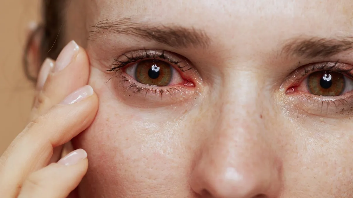 Why Eye Infections Peak During The Rainy Season? Doctor Explains