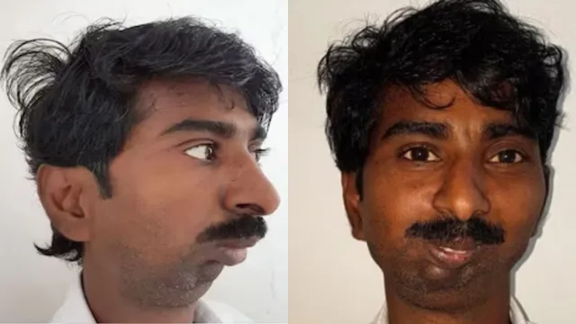 Indian Man’s Jaw-Deformity Photo Turns Racist Meme; Mocked As 'Job ...