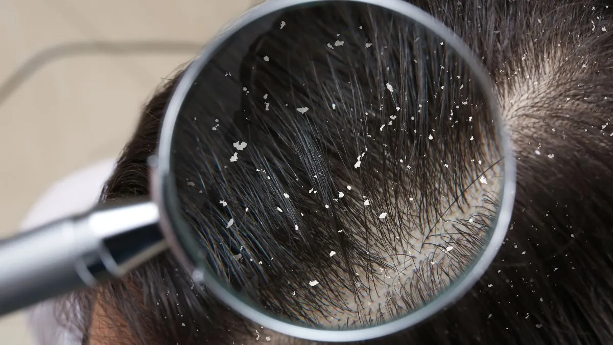 How To Remove Dandruff Fast? Natural Home Remedies To Remove Flakes ...