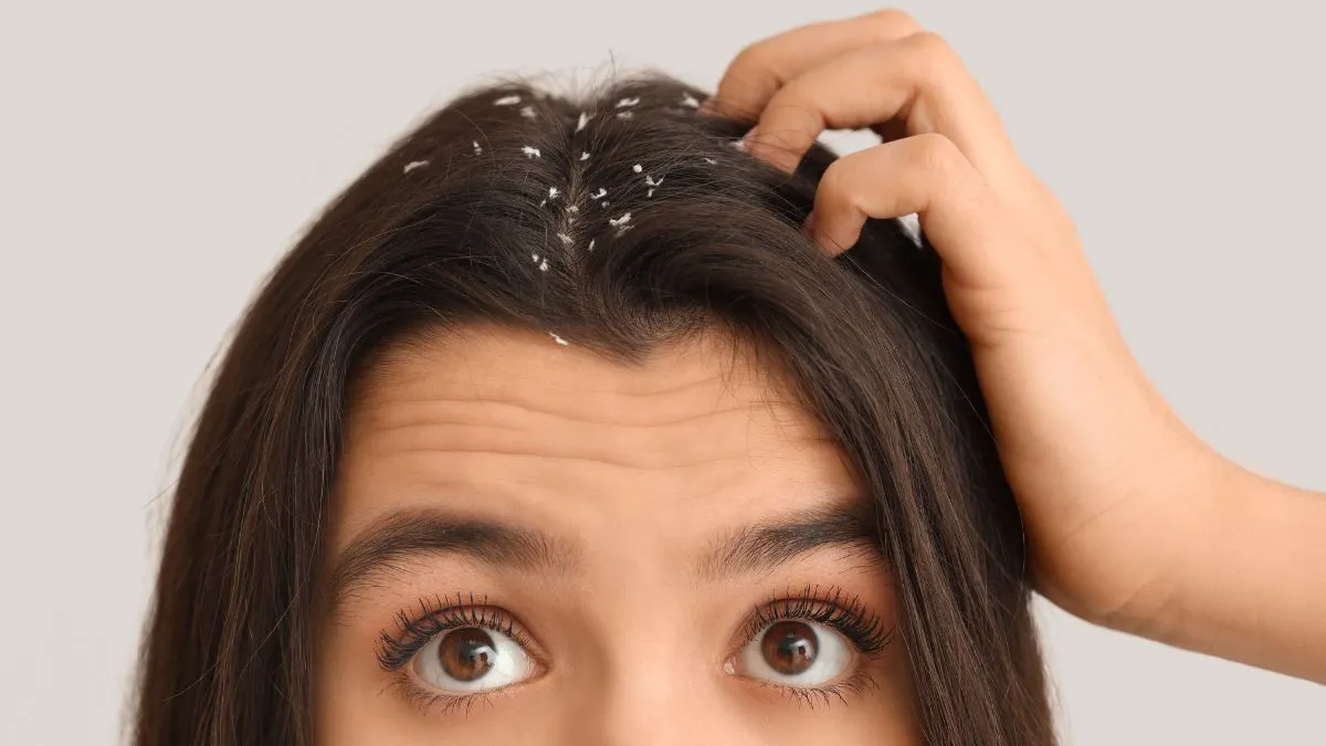 Winter Dandruff And Hair Fall Explained: Doctor Explains How Cold ...