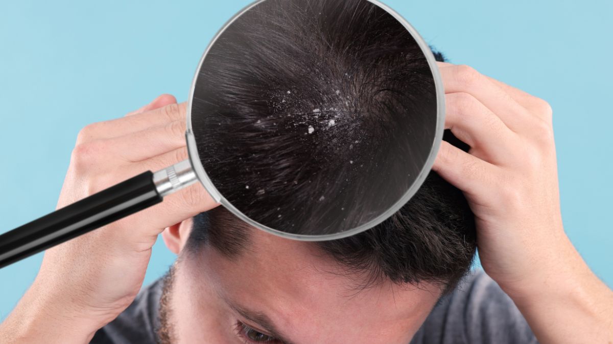 Winter Dandruff And Hair Fall Explained: Doctor Explains How Cold ...