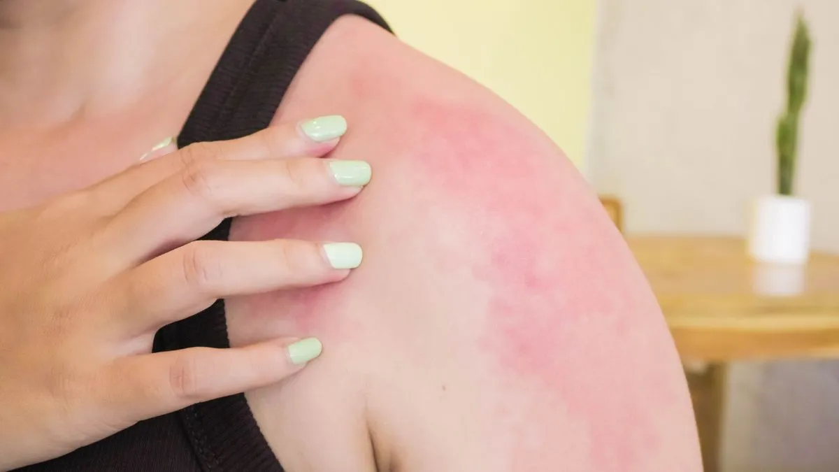 Is Winter Triggering Skin Allergies Like Never Before? Doctor Shares ...