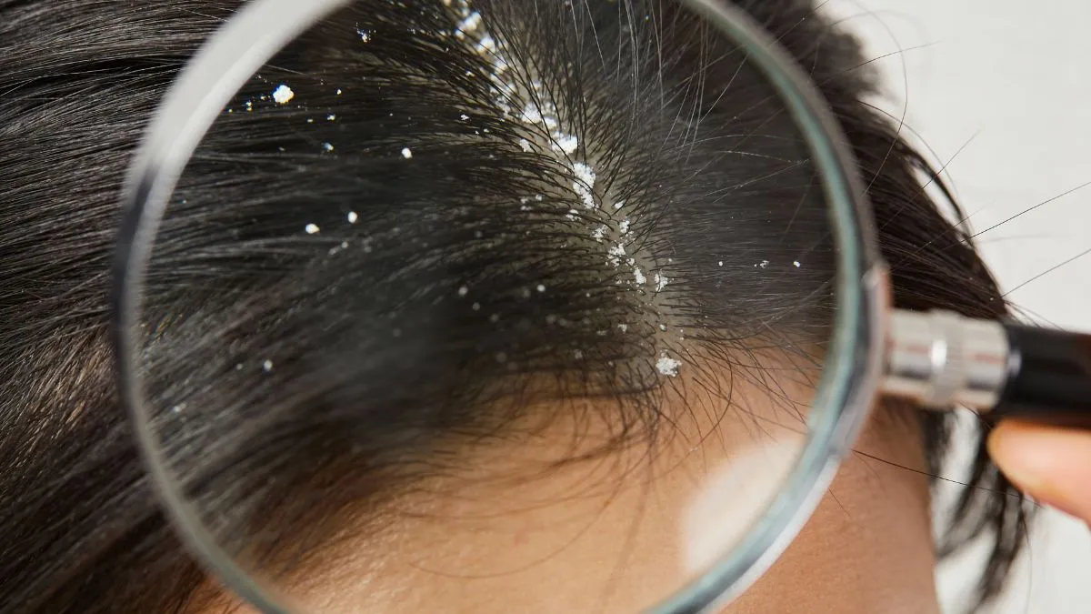 Winter Dandruff And Hair Fall: Doctor Explains How Pollution Disrupts ...