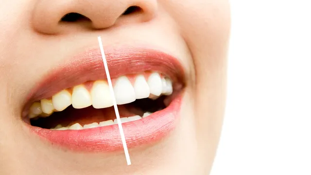 Yellow Plaque on Teeth: The Hidden Culprit Behind Dental Problems