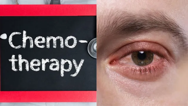 Hidden Side Effects Of Chemotherapy And Radiation On Eyes That No One ...